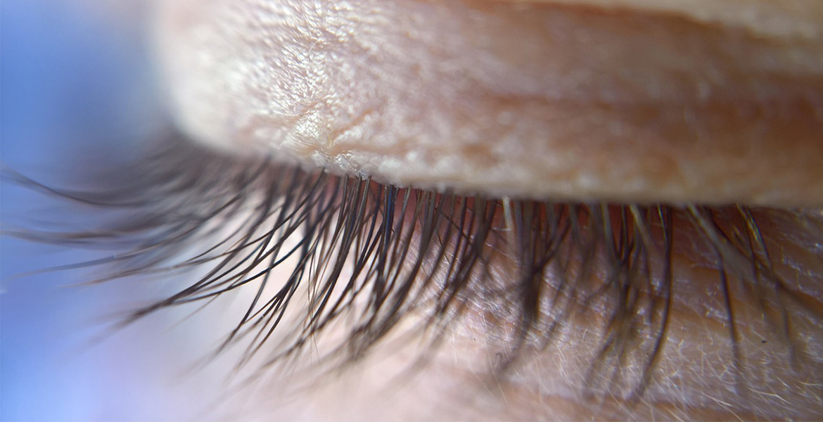 Blefaritis: causas, síntomas y tratamientos - Lenstore.es